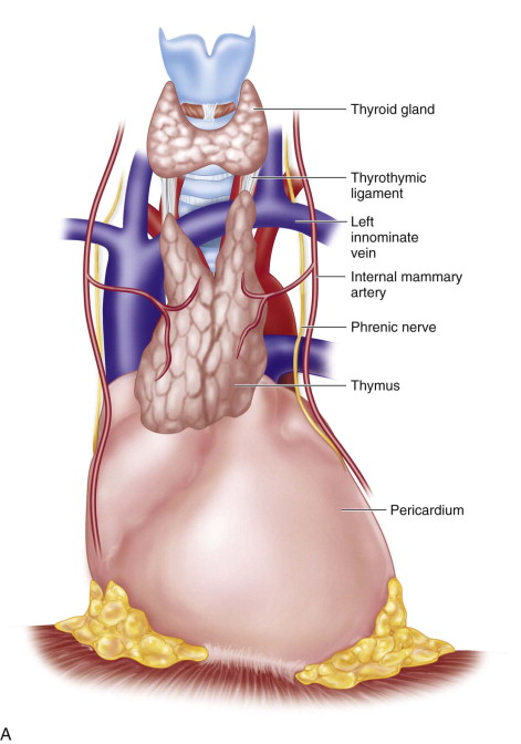 Sternal Splitting Approaches To Thymectomy For Myasthenia Gravis And