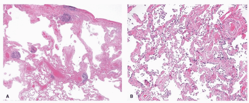 Diffuse Parenchymal Lung Disease Classification And Concepts