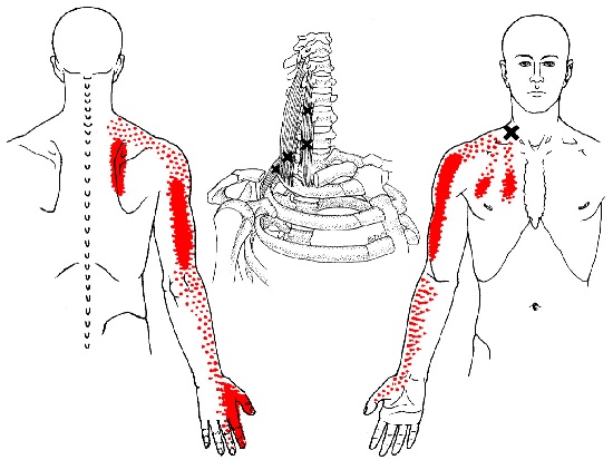 Scalene Trigger Points And Referred Pain Patterns