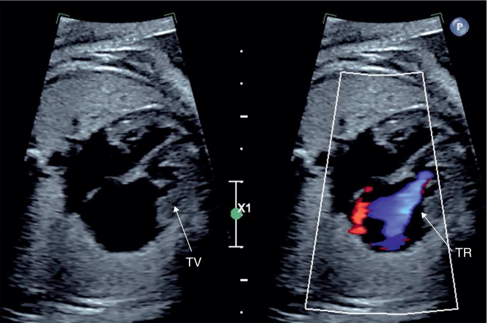 18 Pulmonary Atresia With Intact Ventricular Septum Veterian Key