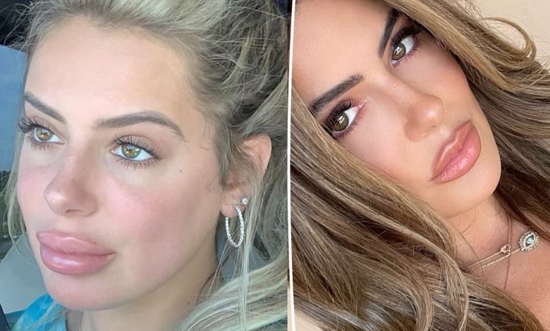 Brielle Biermann Advierte Contra Los Labios Sobrellenados Con