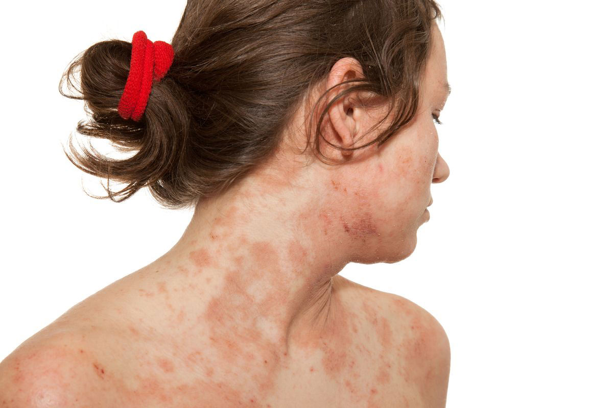 These Pictures Will Help You Identify The Most Common Skin Rashes