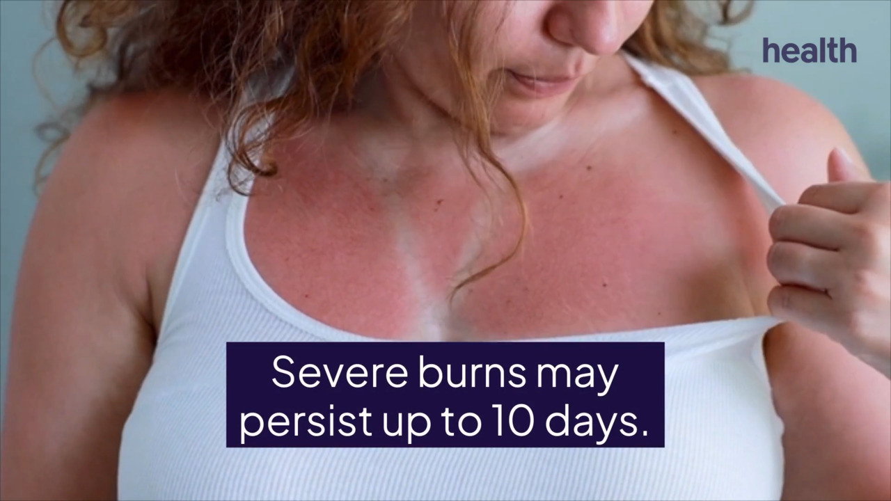 How Long You Can Expect A Sunburn To Last—and How To Treat It