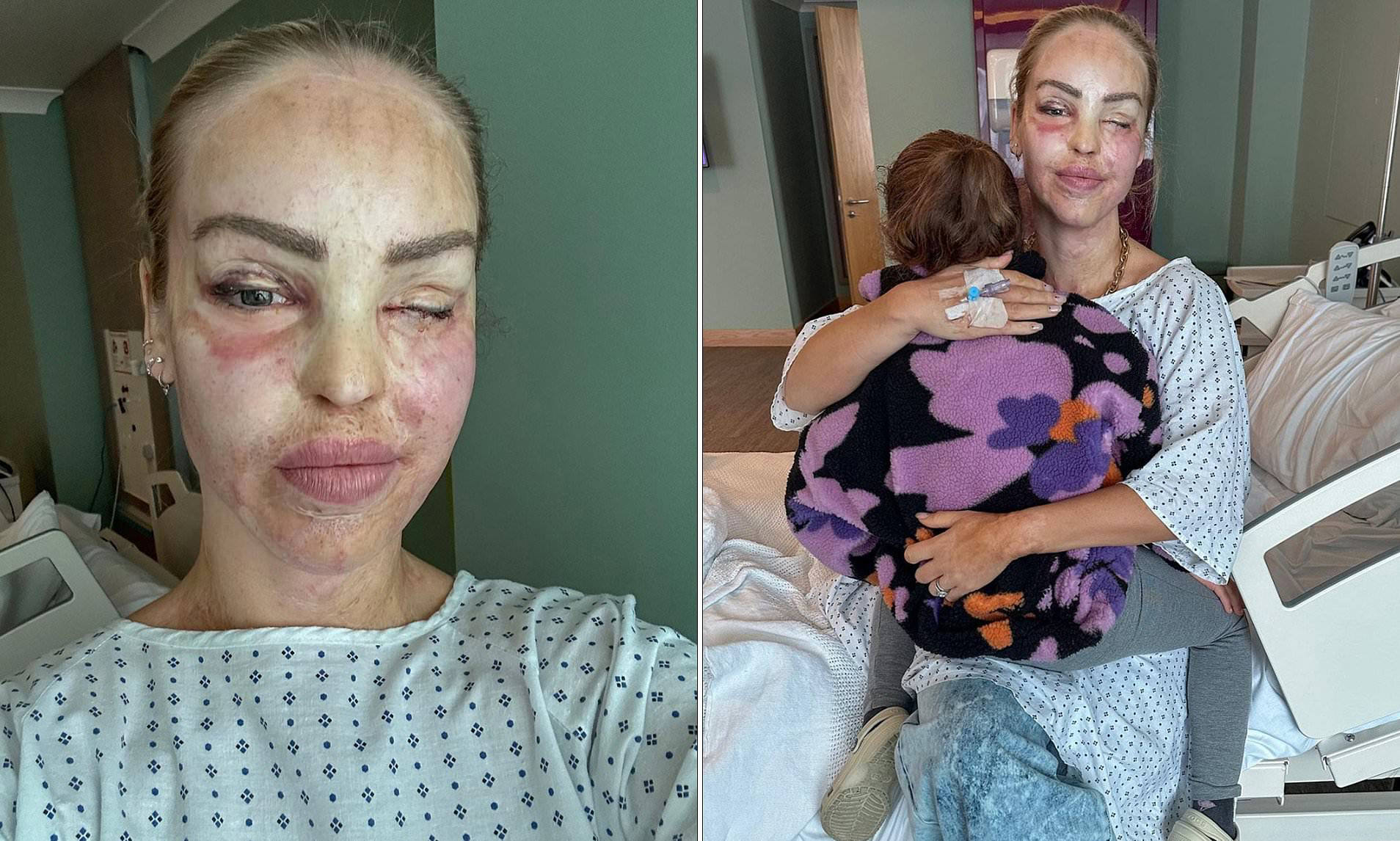 Katie Piper Reveals Shes Undergone Surgery On Her Left Eye