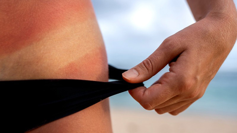 Hot Tips On How To Soothe Painful Sunburnt Skin