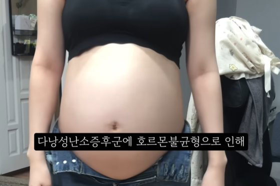 36주 태아 낙태 유튜버 수술 집도의 사산된 아이 꺼낸 것