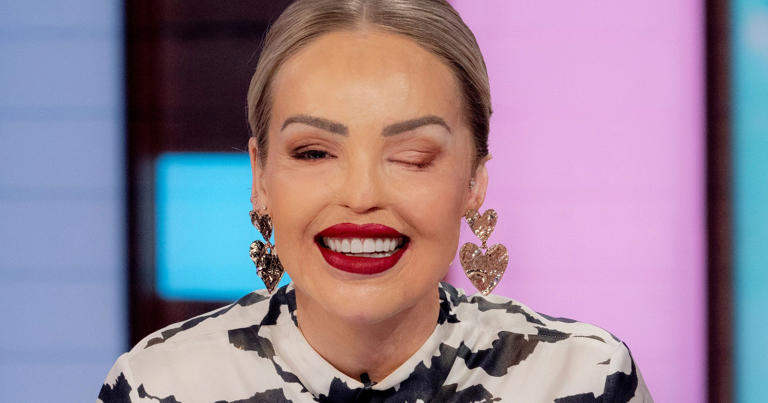 Katie Piper Unveils Dramatic New Look After Having Eye Sewn Shut