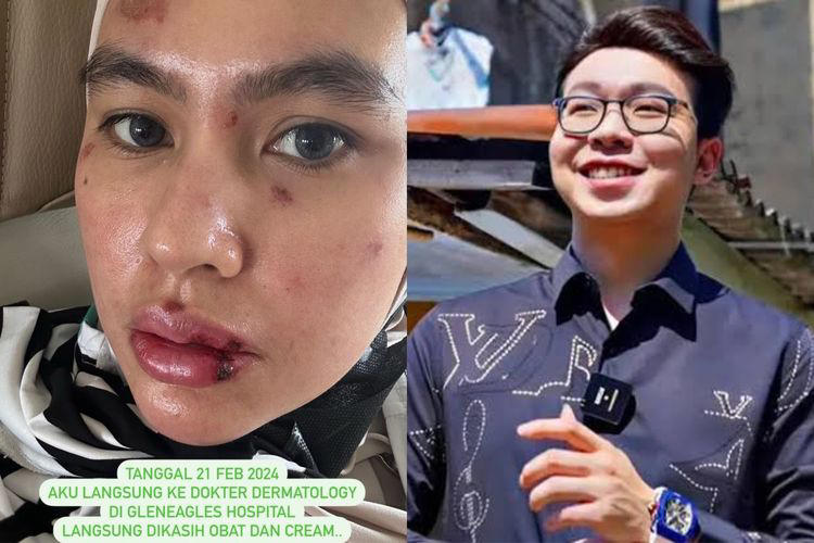 Komentar Dr Richard Lee Usai Tahu Wajah Dan Lidah Kartika Putri Melepuh