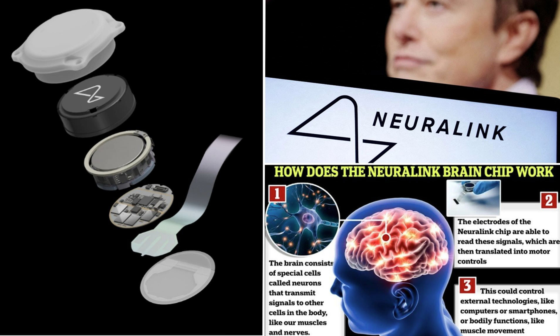 Elon Musk Says First Human Patient Implanted With A Neuralink Brain