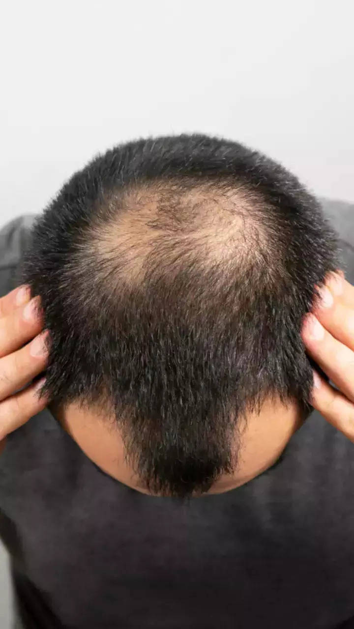 Ultimate Natural Remedies To Reverse Balding