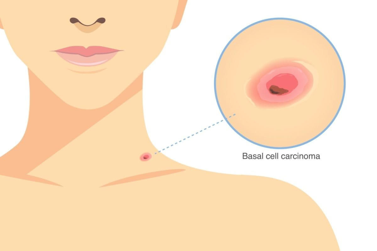 Understanding Basal Cell Carcinoma Causes Prevention And Treatment