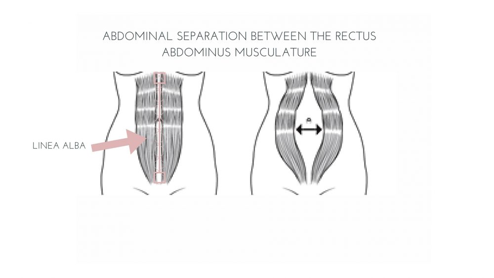 Dram Diastasis Recti What You Need To Know