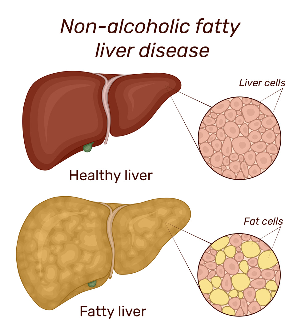 Understanding Fatty Liver Disease Ask The Nurse Expert