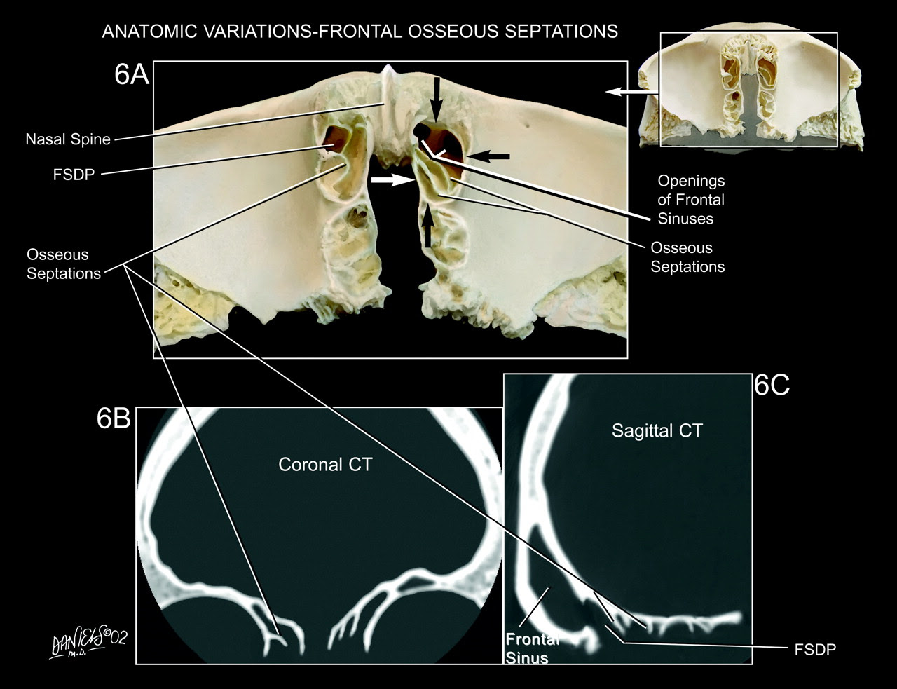 Frontal Nasal Sinus Anatomy Anatomy Structure