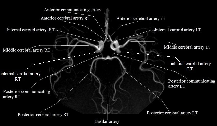 Radiology Anatomy Images Anterior Communicating Artery Anterior