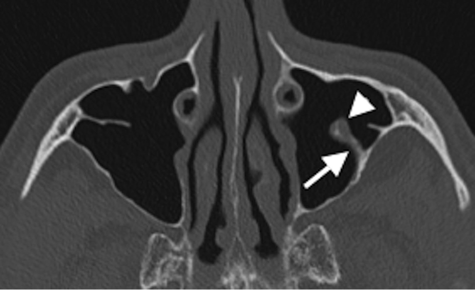 Maxillary Sinus Anatomy