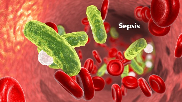 Sepsis Definition Risk Factors Symptoms Diagnosis Treatments And