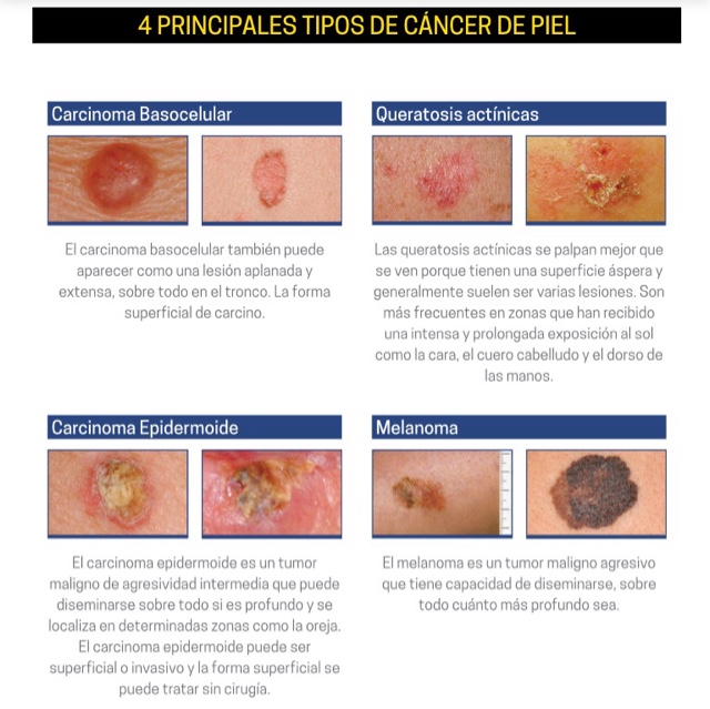 ¿sabes Cuándo Sospechar Un Cáncer De Piel Signos Y Síntomas Para La