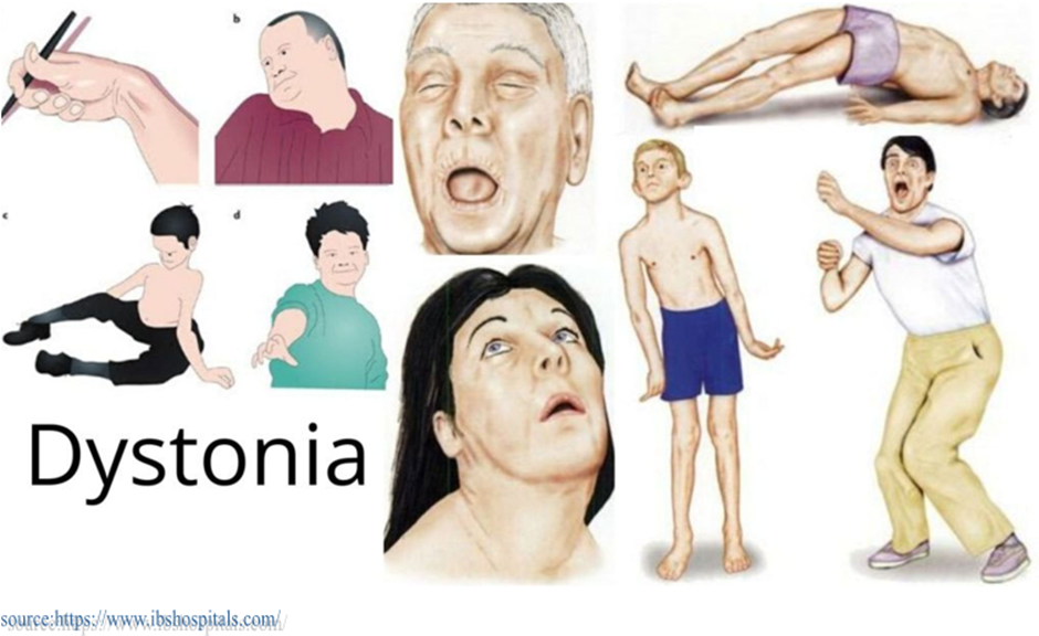 Dystonia Symptoms Causes And Treatments Dr Gurneet Sawhney