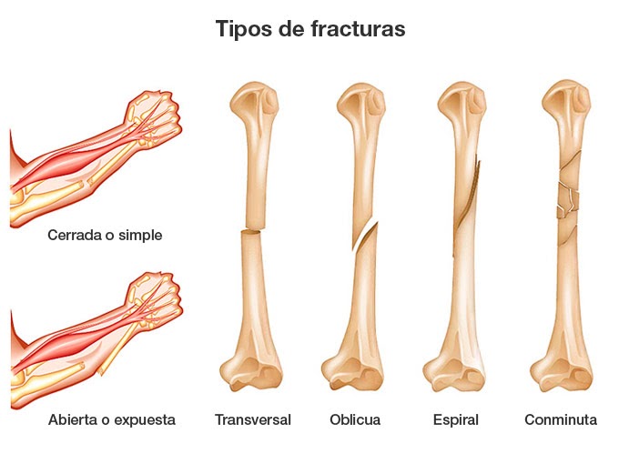 Fracturas Y Torceduras ¿cÓmo Se Clasifican Las Fracturas