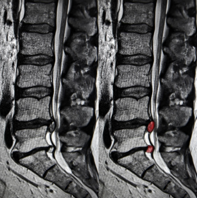 How To Read The Mri For A Herniated Disc And 5 Treatment Options