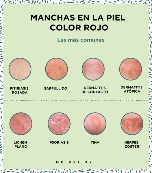 Manchas En La Piel Causas Tipos Y Tratamientos