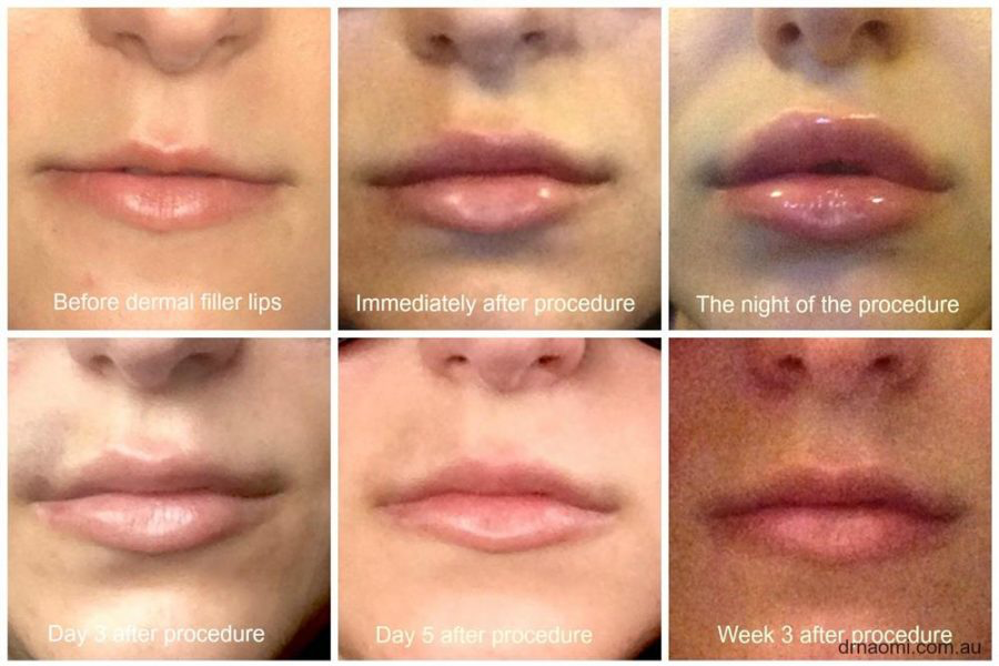 How To Decrease Swelling From Lip Injections