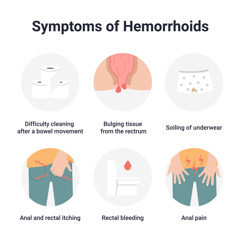 Avoid Hemorrhoids Unveiling Common Causes And Prevention