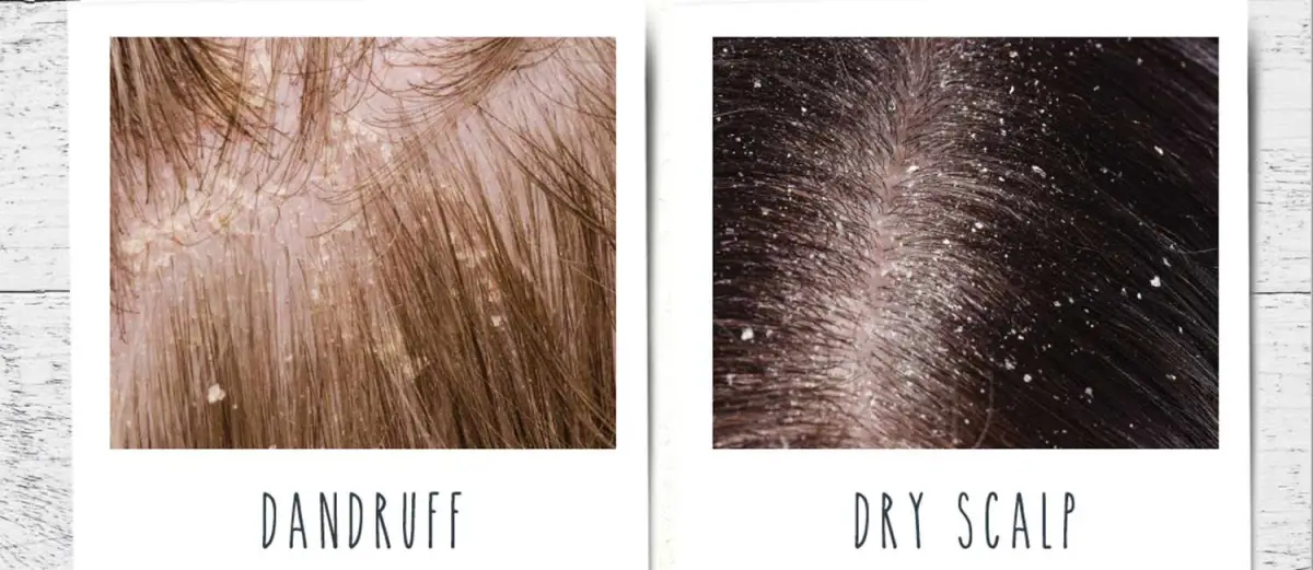 Dandruff Vs Dry Scalp Key Differences And Treatment Options