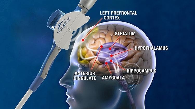 Vns Therapy Vagus Nerve Stimulation You Can Treat Depression With