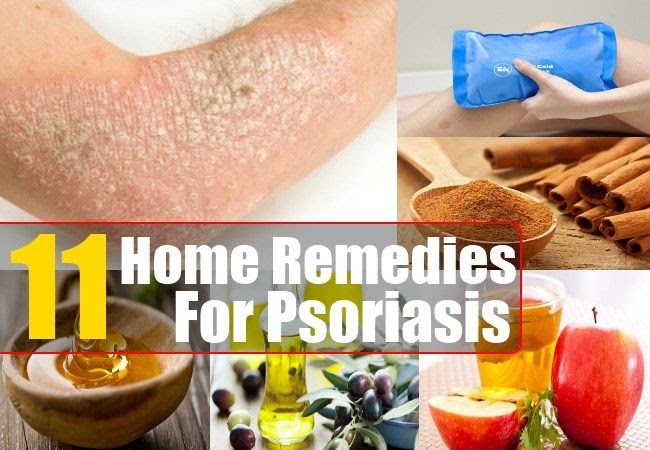 Home Remedies For Psoriasis Natural Treatments And Cure For Psoriasis