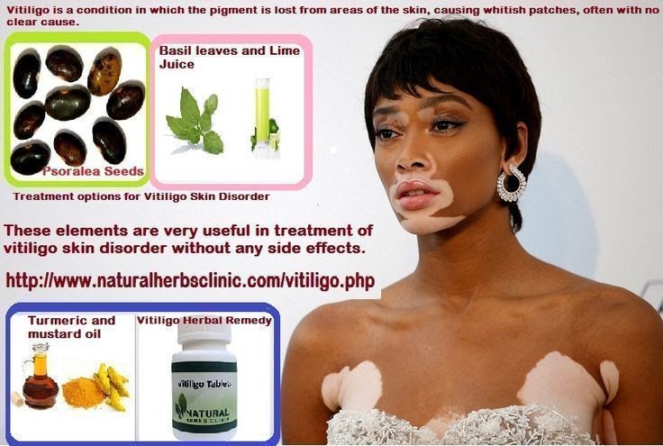 Vitiligo Treatment Options