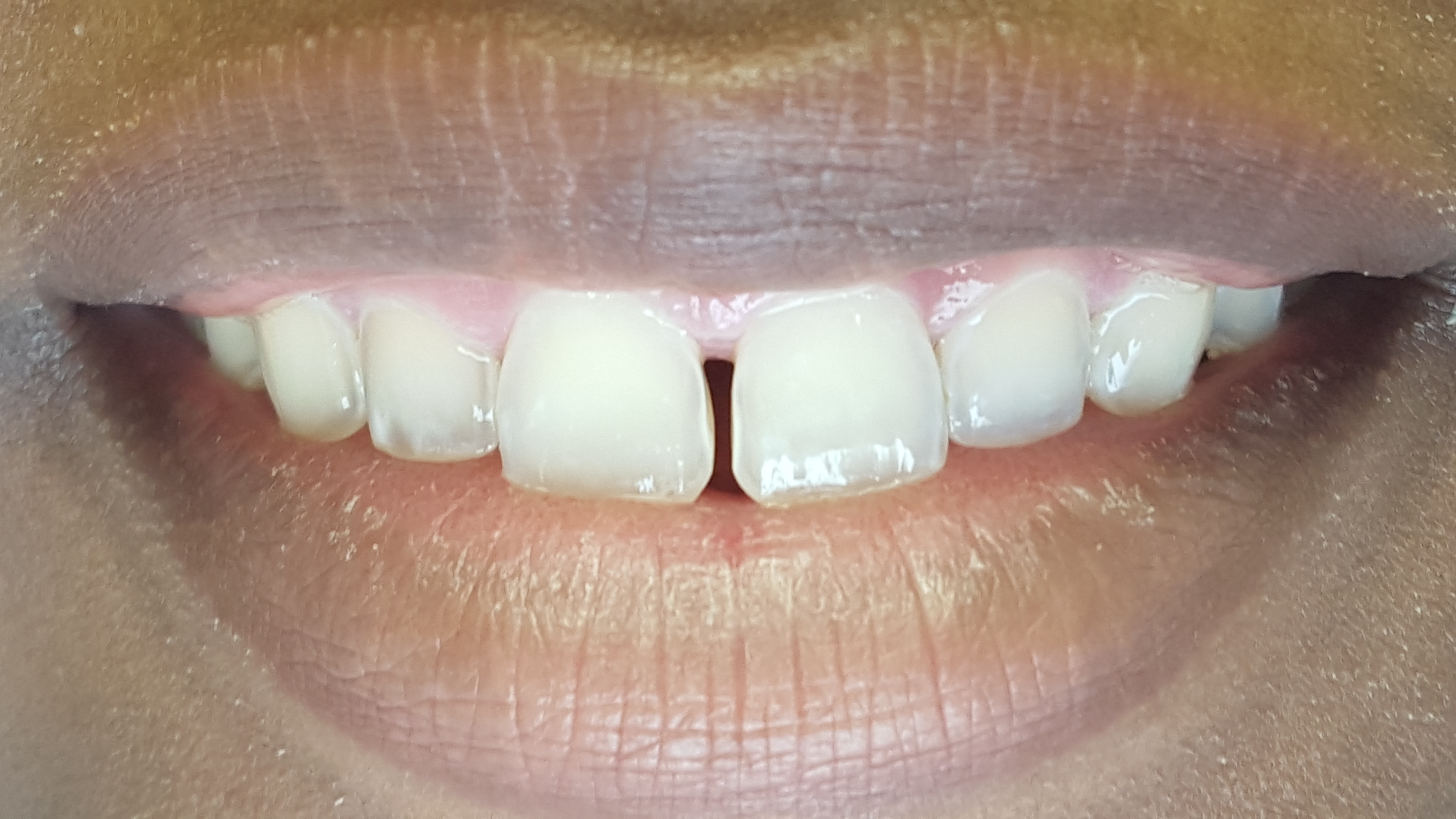 How To Cover Up A Gap In Your Teeth Teethwalls