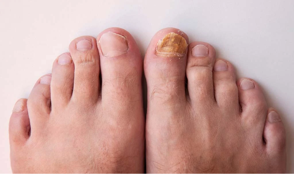 How To Get Rid Of Foot Fungus Healthcare Business Today