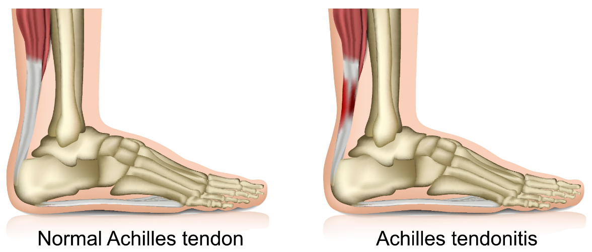 Achilles Tendinopathy What Is It And How Do We Take Care Of It