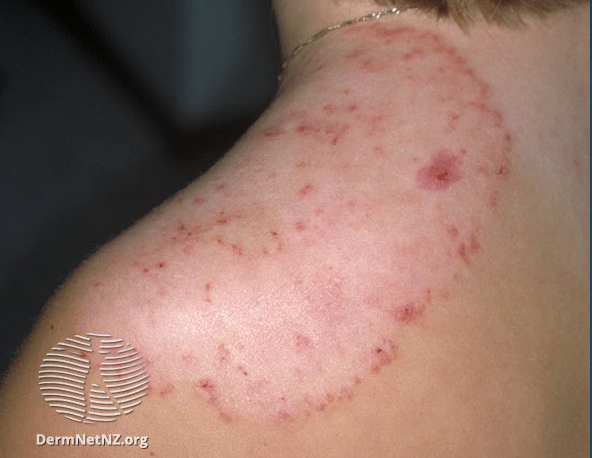 Psoriasis Vs Fungal Infections Photos And Differences In Symptoms