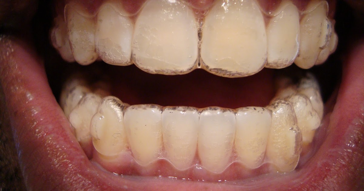 Invisalign Experience 2011