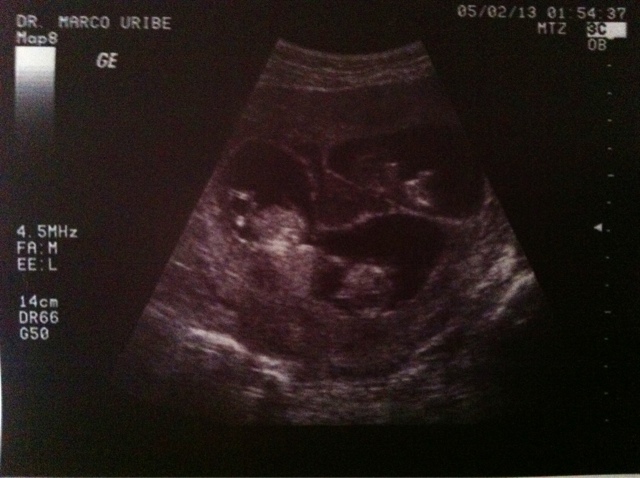 The Texas Trio A Triplet Pregnancy Blog 11 Weeks