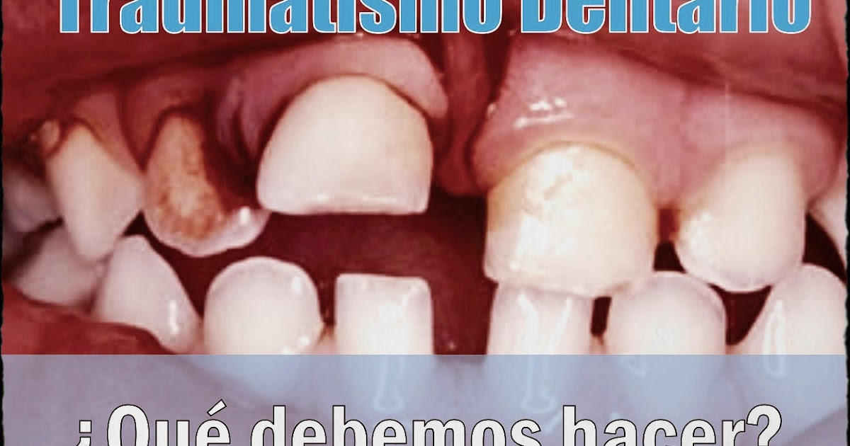 Trauma Dental ¿qué Debemos Hacer Ante El Traumatismo Dentario De Los