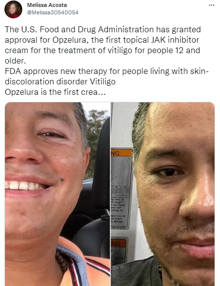 Opzelura Is The Only Fda Approved Nonsegmental Vitiligo Cure Misbar