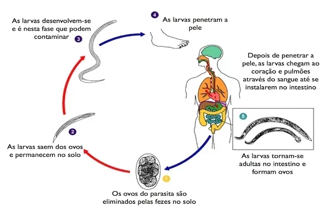 Ancilostomíase O Que é Causas Sintomas E Diagnóstico Sanarmed