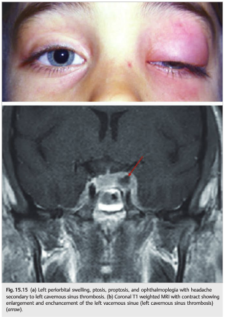 Neuro Ophthalmology Illustrated Chapter 15 Cavernous Sinus And