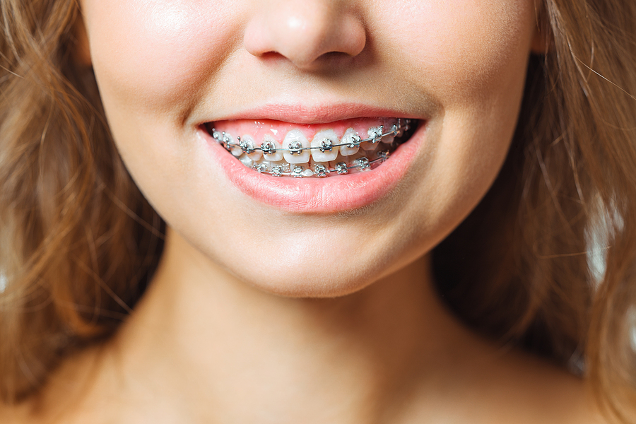 Ceramic Braces Treatment Cost And Professional Advice