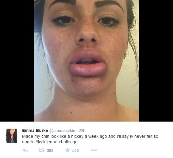 Kylie Jenner Lip Challenge Bad Effects Famous Person