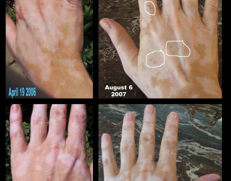 Natural Vitiligo Vitiligo Treatment Kenya Vitiligo Depigmentation