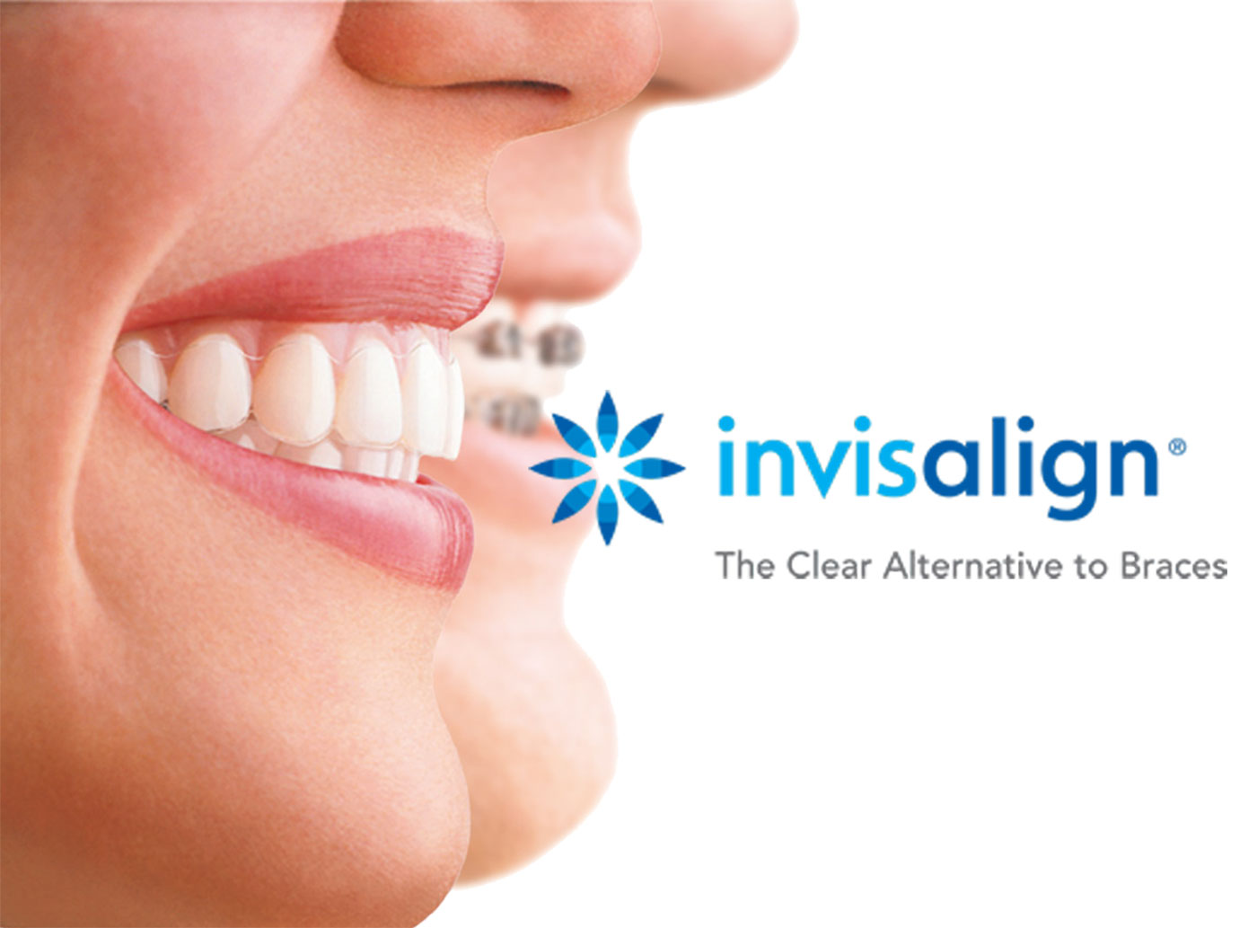 Invisalign The Ivory Dental Clinic