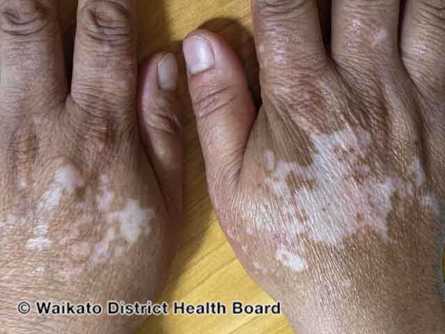 Eczema And Vitiligo Whats The Connection Myvitiligoteam