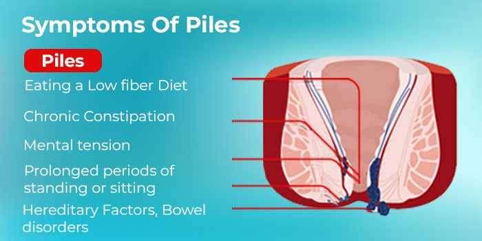 Piles Laser Treatment In Hyderabad Internal External Hemorrhoids