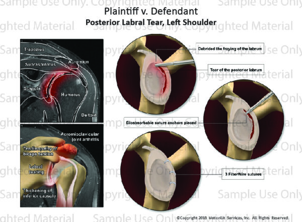 Posterior Labral Tear Injury Motionlit