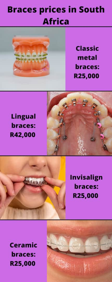 How Much Are Braces In South Africa 2024 Braces Price And Infographic